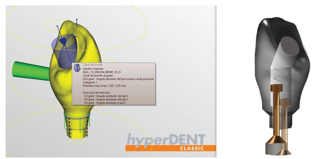 VALIDACIÓN DE LA DMTONE DE DYNAMIC ABUTMENT® SOLUTIONS CON HYPERDENT ...