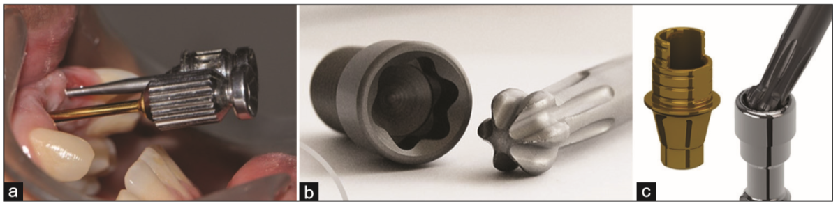 Casos Prácticos Archives - Dynamic Abutment Solutions ES