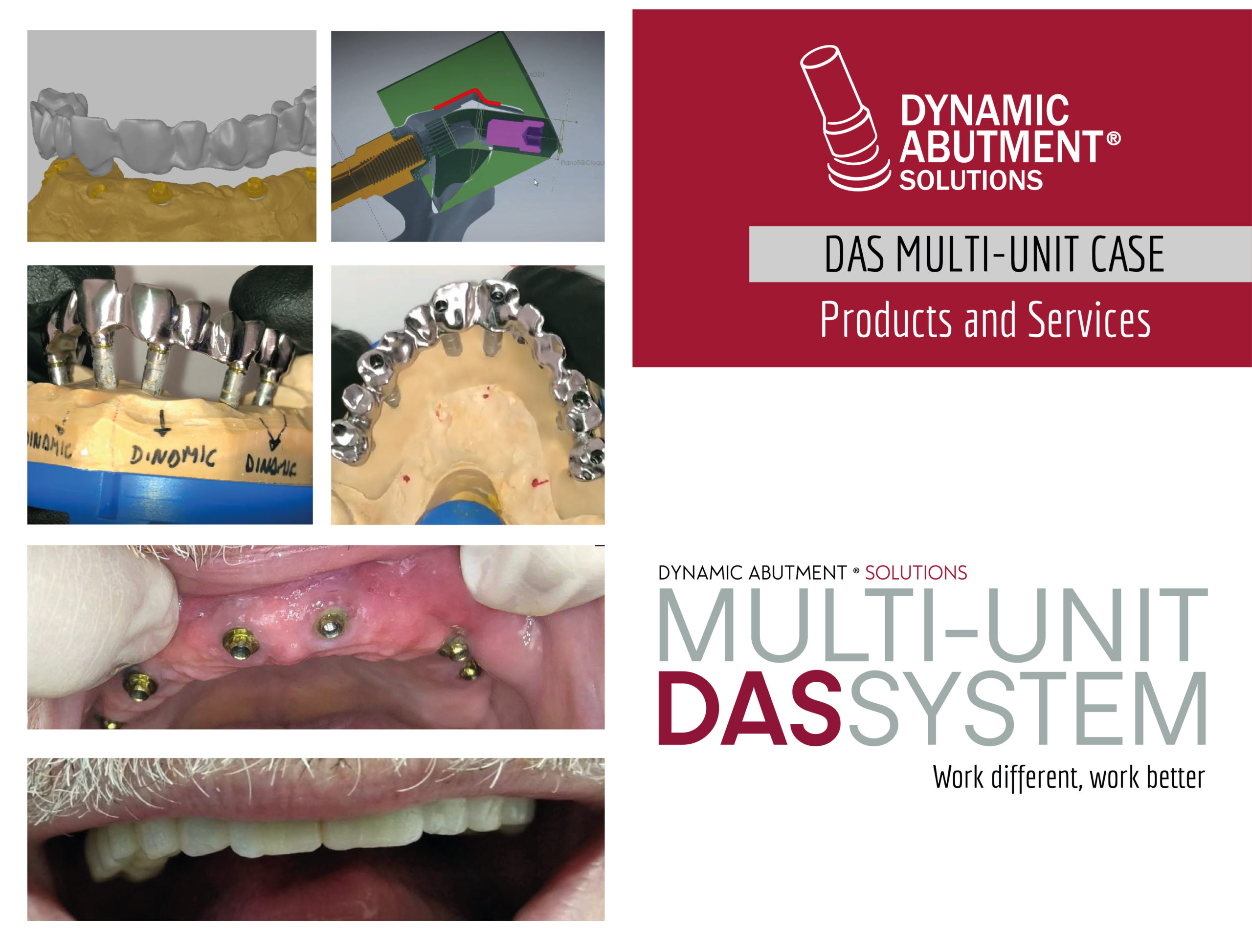 CASO RESUELTO CON MULTI-UNIT DAS SYSTEM - Dynamic Abutment Solutions ES